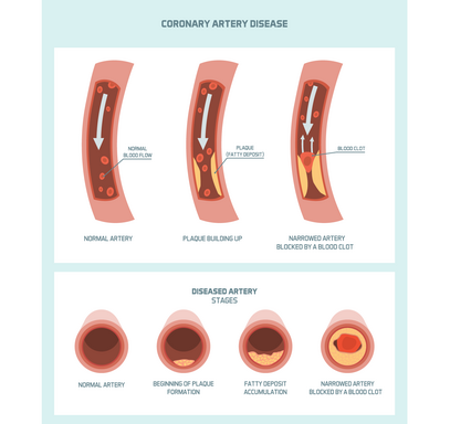 Heart attack: causes and warning signs • HRI • Heart Research Institute NZ